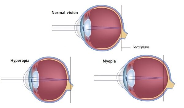 LASIK Kansas City | LASIK Eye Surgery Missouri | Discover Vision