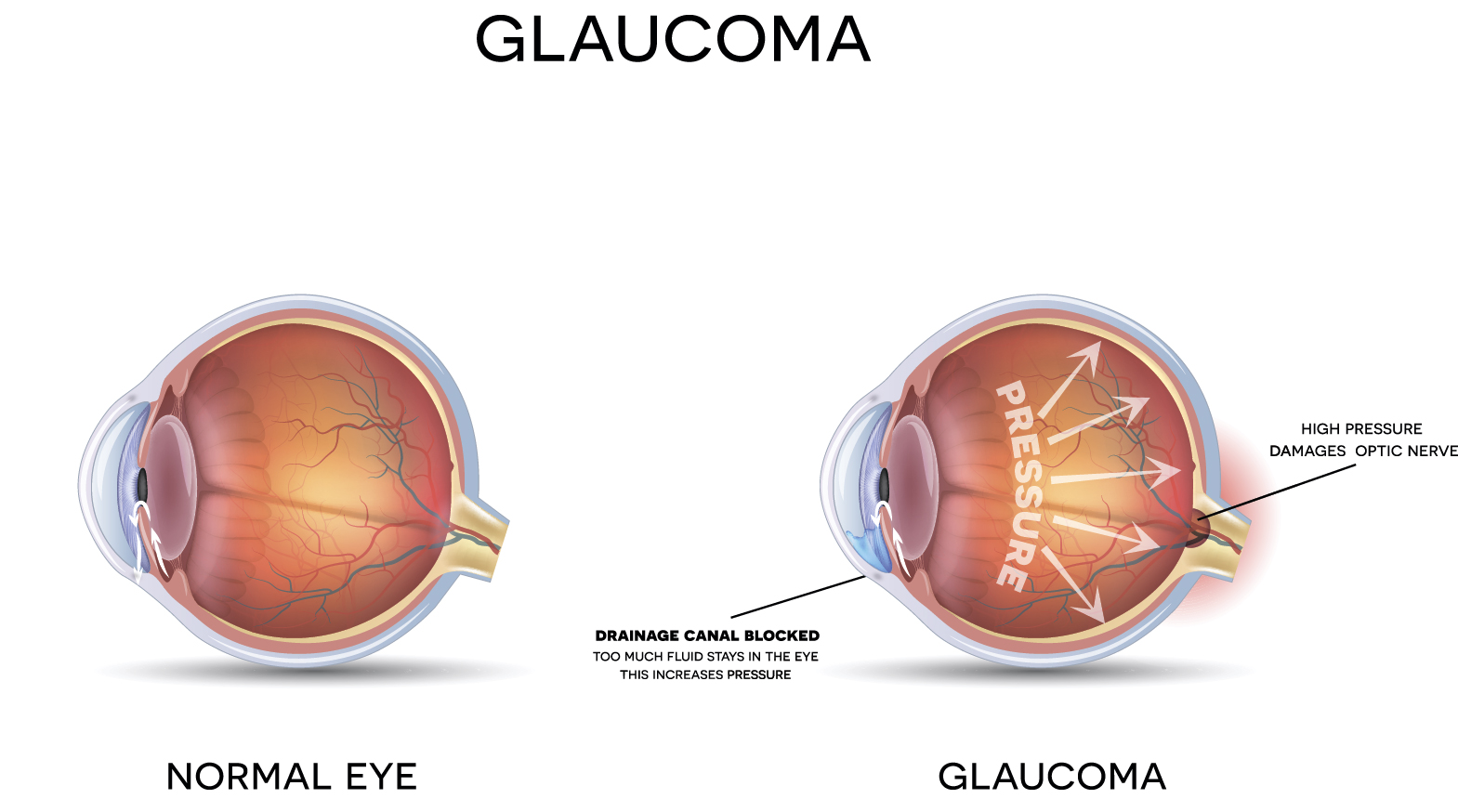 Diabetic Eye Care in Kansas City, MO | Discover Vision