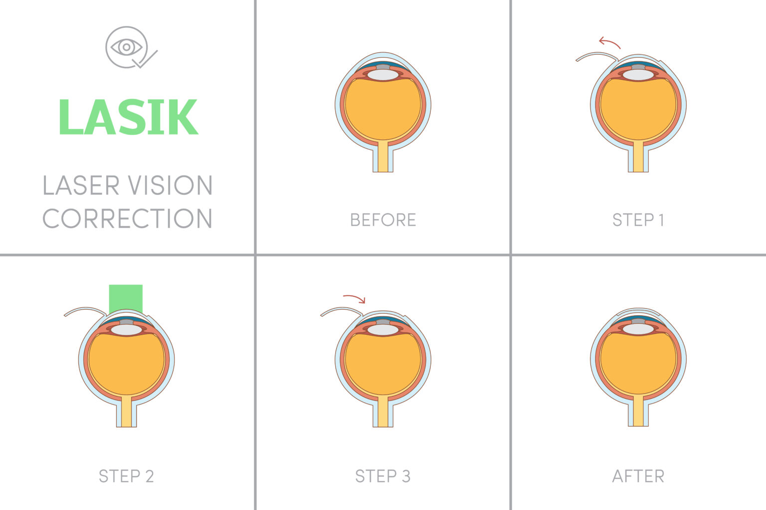 LASIK for Nearsightedness (Myopia) in Kansas City | Discover Vision