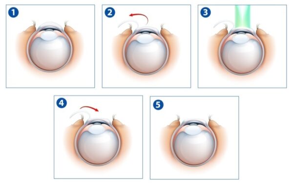 LASIK for Astigmatism in Kansas City, MO| Discover Vision