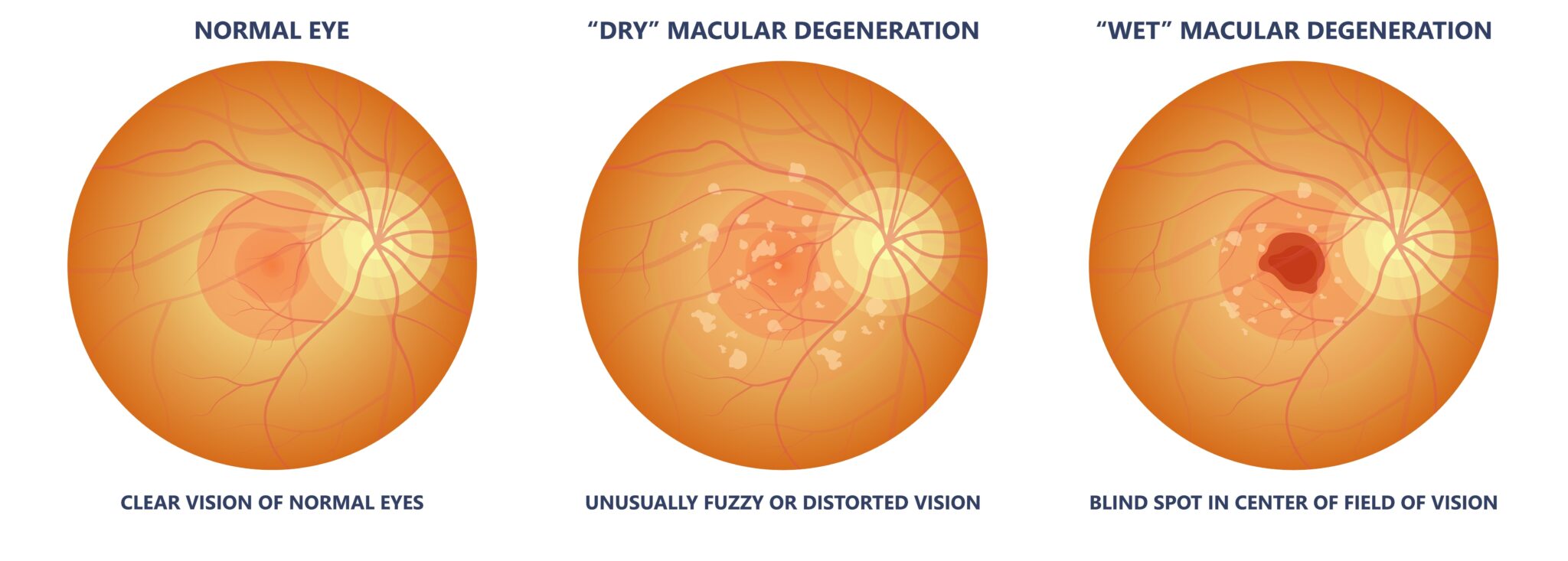 Macular Degeneration Treatment in Kansas City, MO | Discover Vision