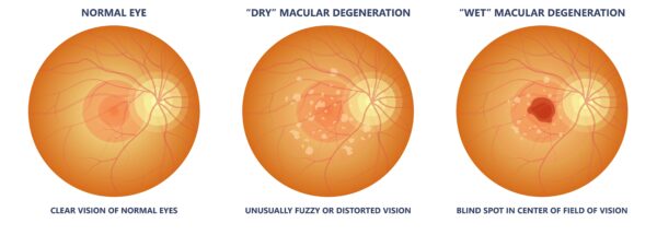 Macular Degeneration Treatment in Kansas City, MO | Discover Vision