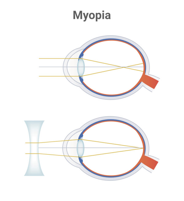 Myopia Surgery in Kansas City, MO | Discover Vision