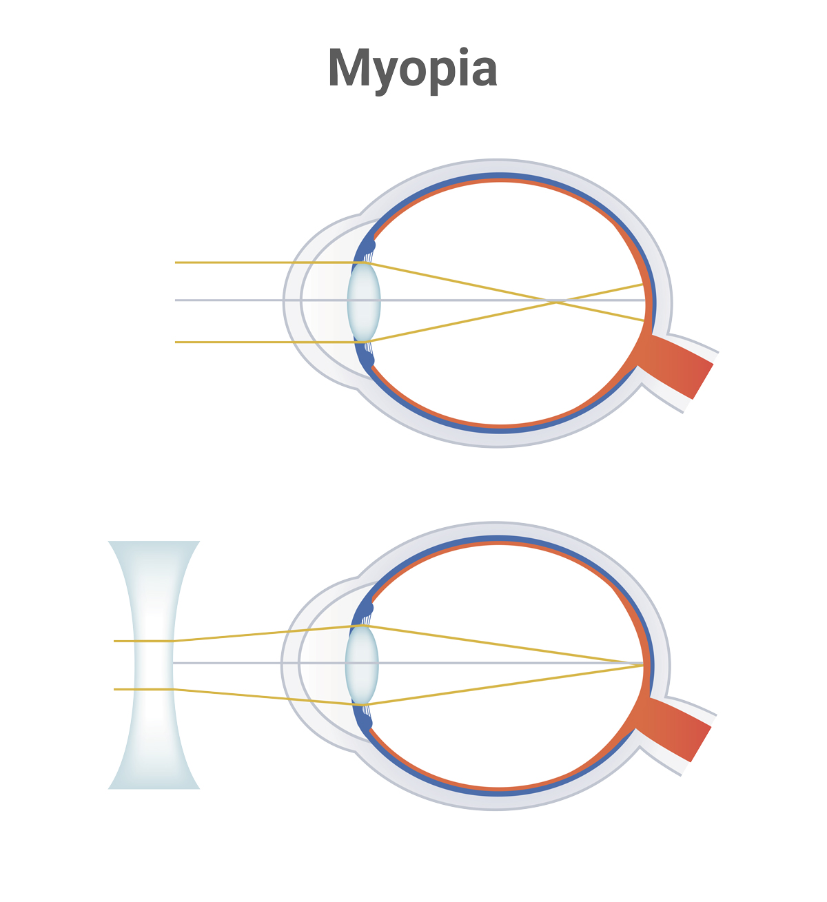 Myopia Surgery in Kansas City, MO | Discover Vision