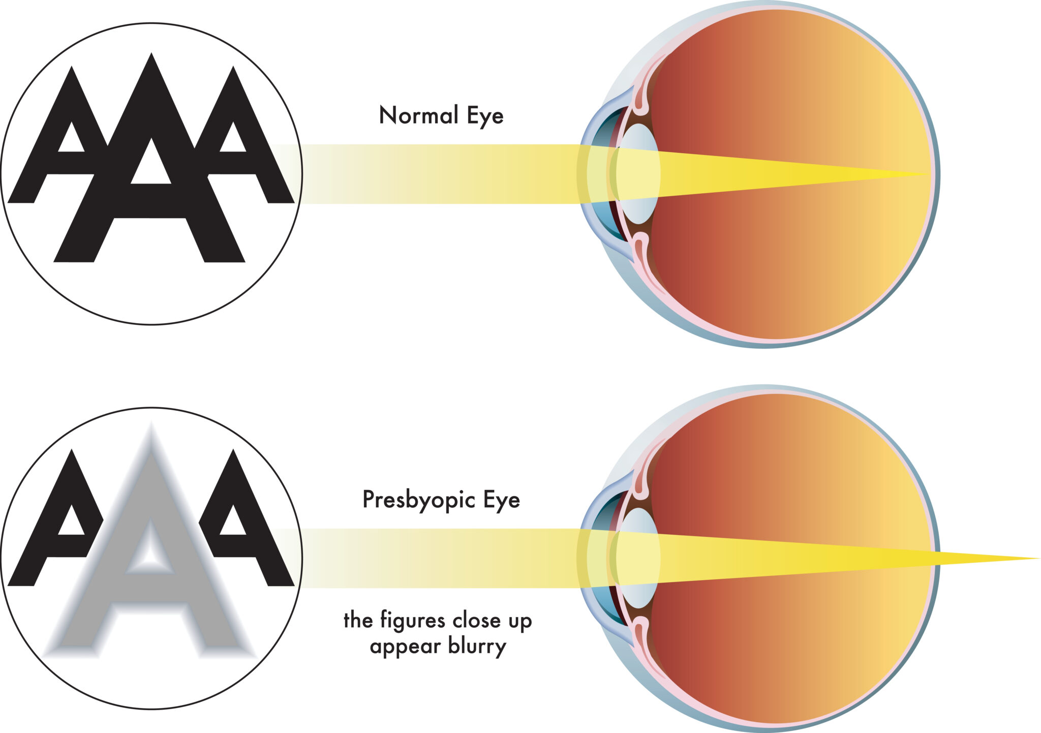 Presbyopia Treatment in Kansas City, MO | Discover Vision