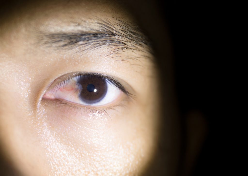 Pterygium Surgery in Kansas City, MO | Discover Vision