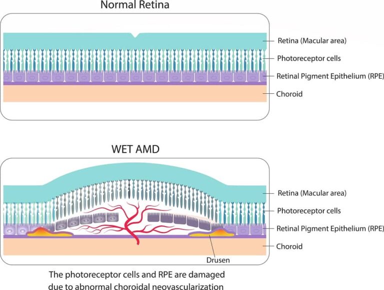 Wet vs. Dry Macular Degeneration: What’s the Difference? | Discover Vision