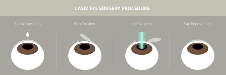 How Successful Is LASIK For Farsightedness?