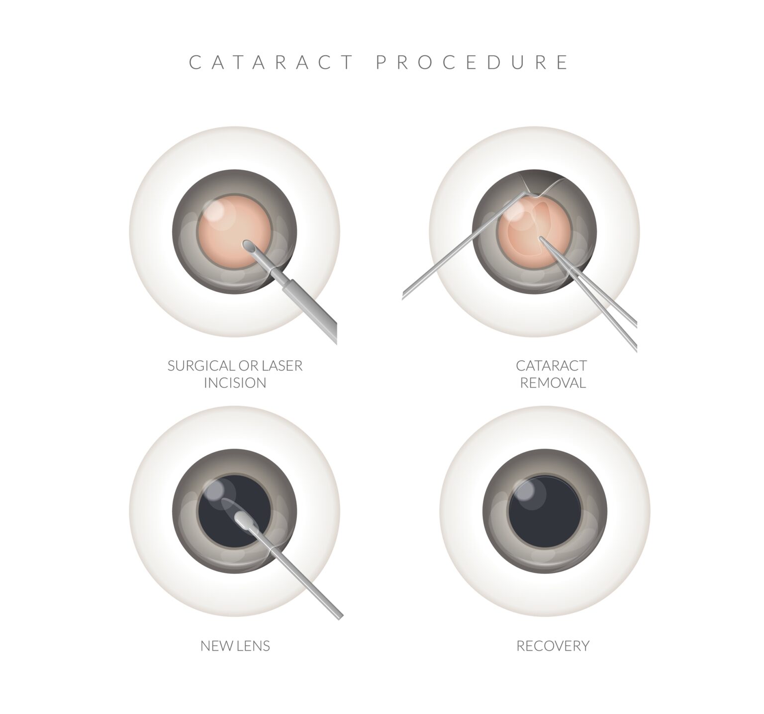 Cataract Surgery in Kansas City, MO | Discover Vision