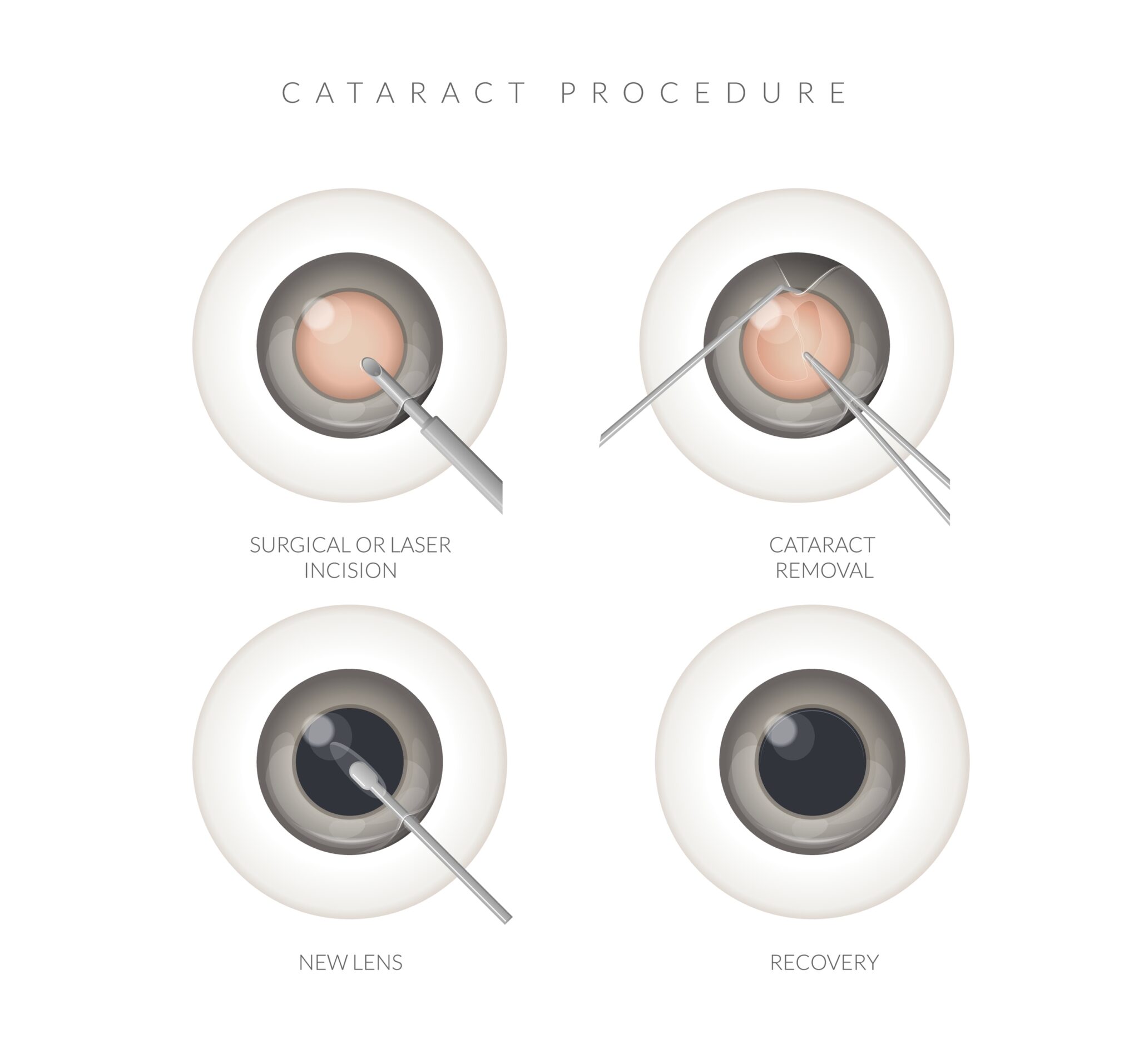 Cataract Surgery in Kansas City, MO | Discover Vision