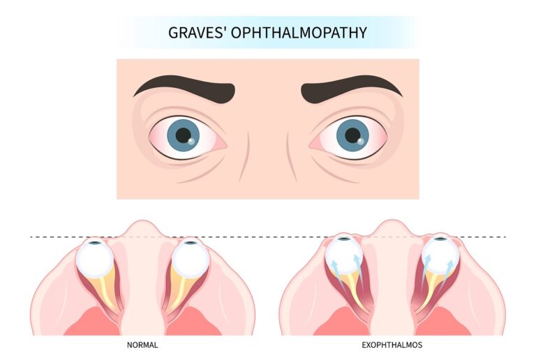 Thyroid Eye Disease (TED) Treatment in Kansas City, MO | Discover Vision